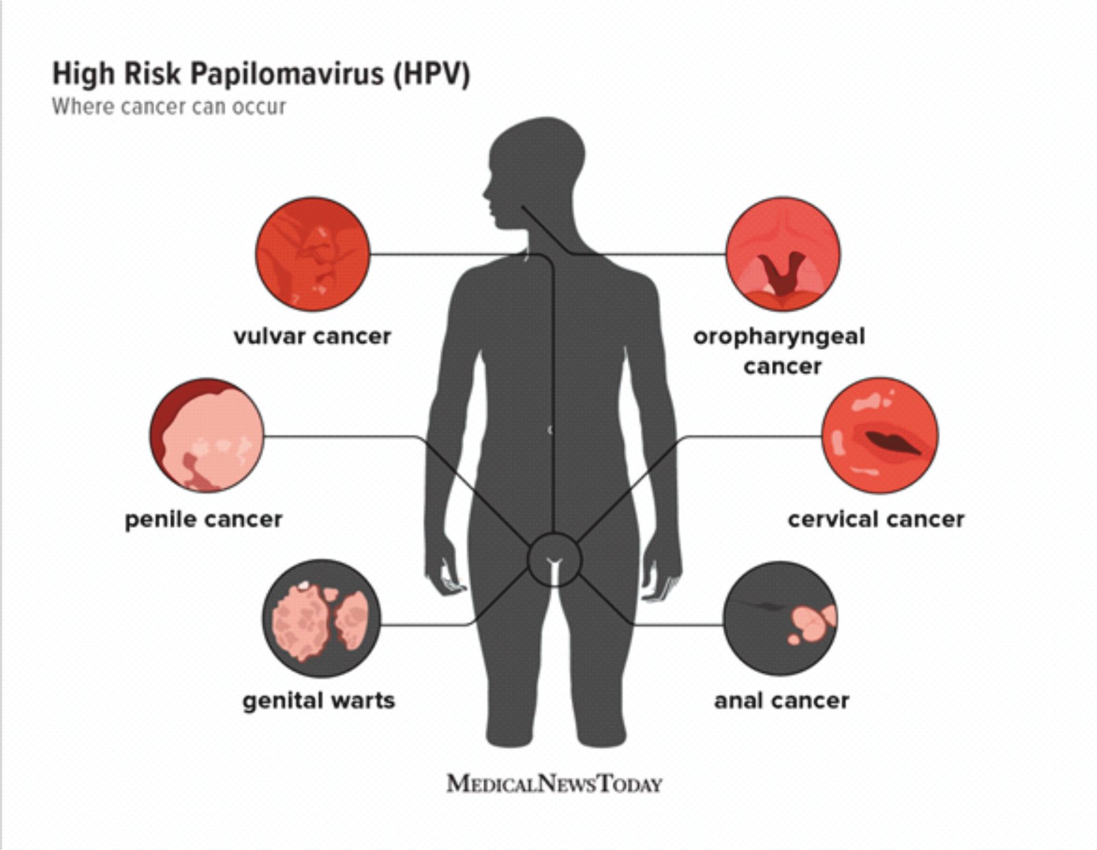 HPV VACCINE | Current Affairs Editorial, Notes by VajiraoIAS